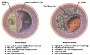 Advanced Cardiovascular Screening - Rock Creek Wellness